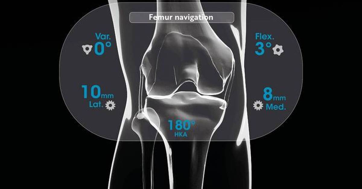 Pixee Medical Announces the U.S. Launch of Knee+ NexSight at the AAOS ...