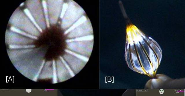 CardioFocus Announces First Patients Treated with OptiShot™ Pulsed ...