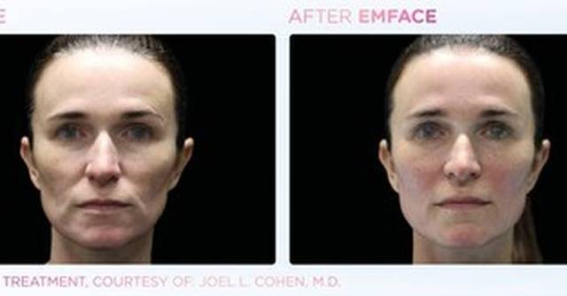 BTL's EMFACE Surpasses 1 Million Treatments, Becoming the Fastest ...