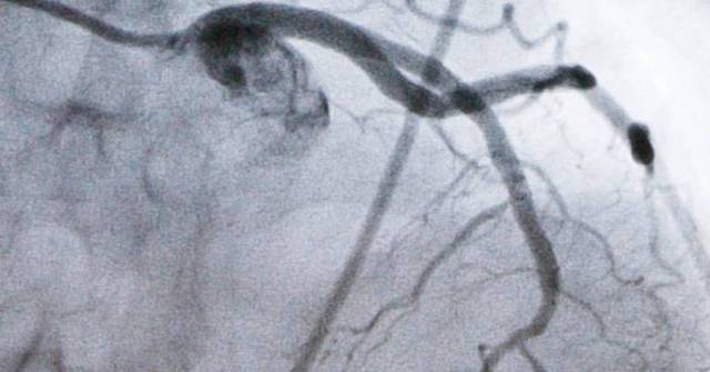Experimental cholesterol-lowering pill may offer new option for millions